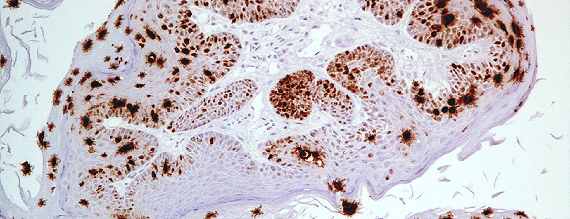 From Precursor Lesion to HPV-Associated Cancer - PapiVax Biotech, inc.